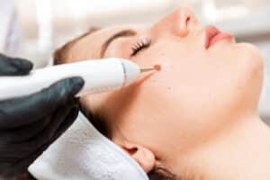 5 Dos and Don’ts for Quick Recovery After Laser Mole Removal