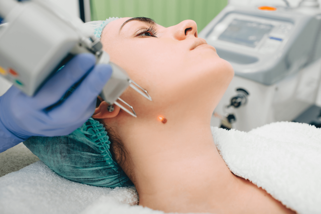 All About Laser Mole Removal: Key Benefits and Risks